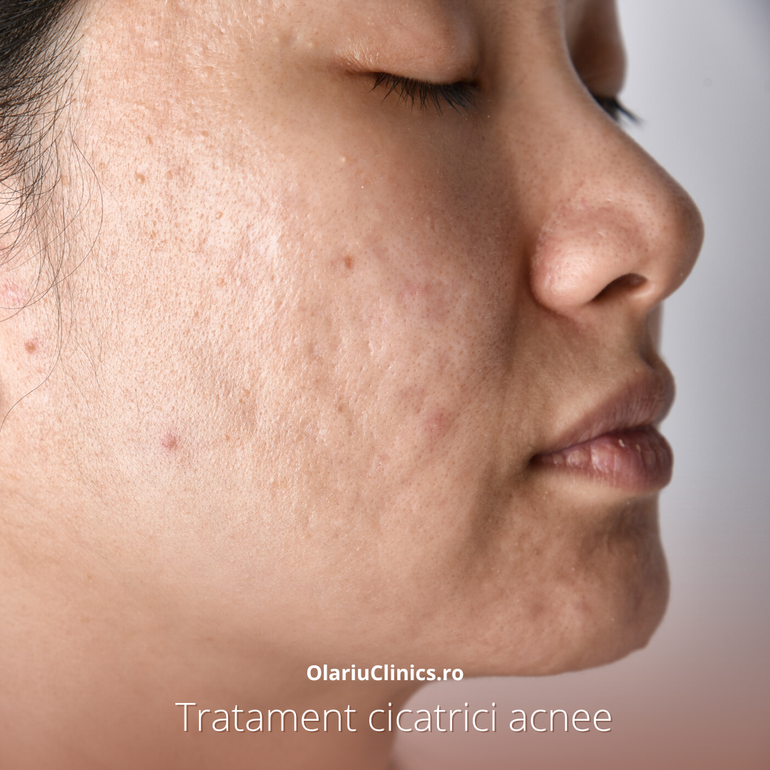 Tratament cicatrici acnee - Olariu Clinics | Chirurgie Plastica ...